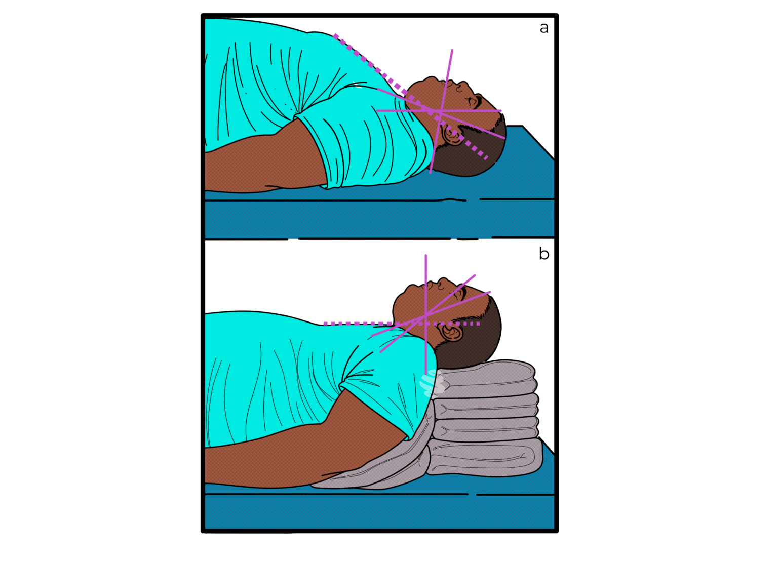 Confira o guia de Sequência Rápida de Intubação (SRI)