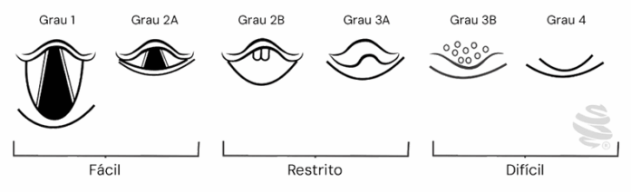 Estratégias de avaliação de via aérea: Classificação Mallampati e ...