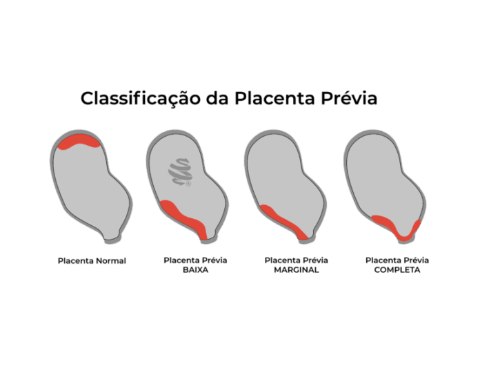 Placenta prévia: o que é, sintomas, diagnóstico e tratamento