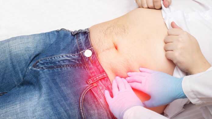 Diverticulite: saiba o que é, sintomas, causas e tratamento