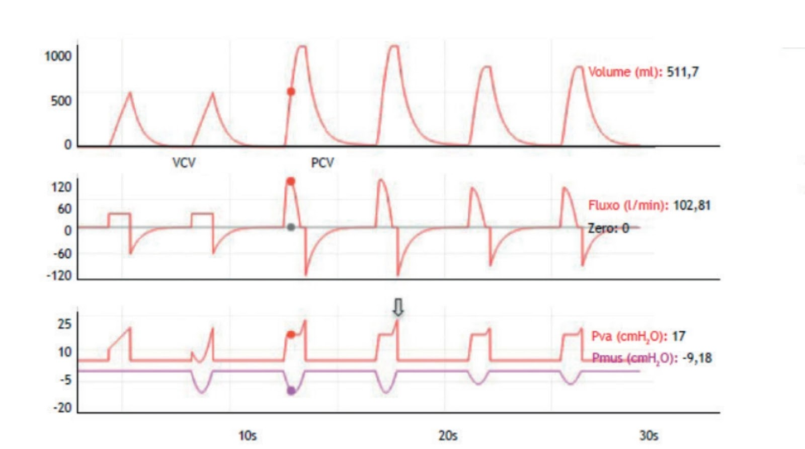 Saiba a técnica correta da Ventilação Mecânica - Blog de Medcof ...
