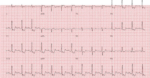 Síndromes Coronarianas Agudas (SCA): Descubra como elas aparecem no ECG ...
