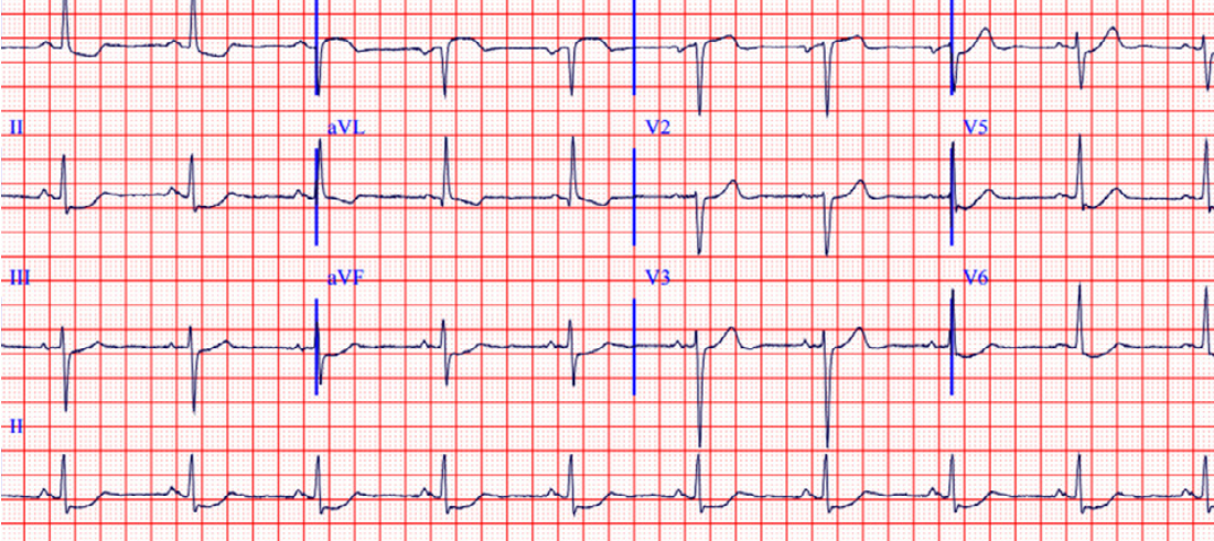 Síndromes Coronarianas Agudas (SCA): Descubra como elas aparecem no ECG ...