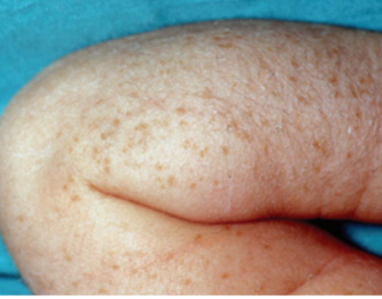 Dermatite atópica em bebês e Lesões Neonatais - Blog de Medcof ...